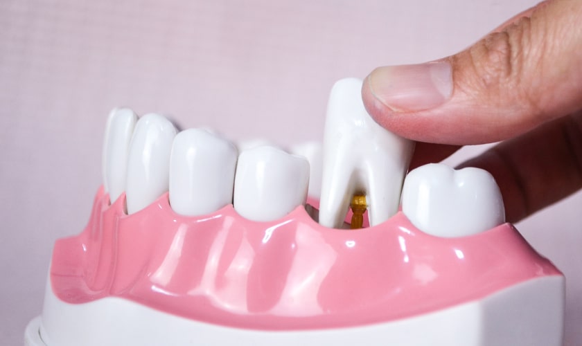 How-To Guide for Getting Your Teeth Out Smoothly?